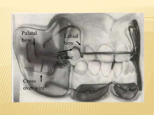 Frankel’s appliance | PPTX | Ear, Nose and Throat Conditions | Diseases ...