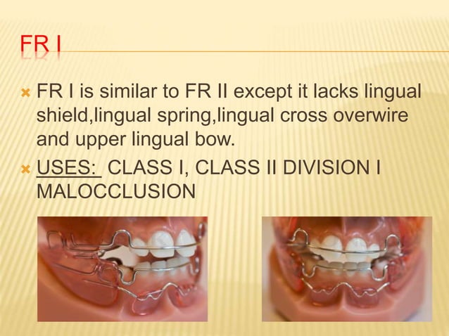 Frankel’s appliance | PPTX | Ear, Nose and Throat Conditions | Diseases ...