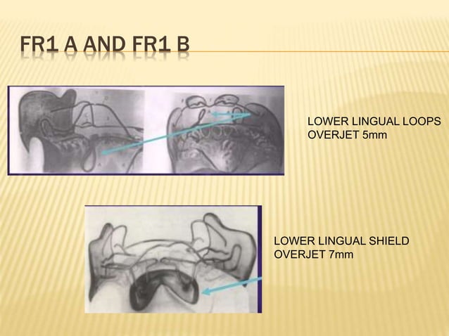 Frankel’s appliance | PPTX | Ear, Nose and Throat Conditions | Diseases ...