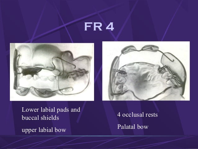Frankel’s functional regulator