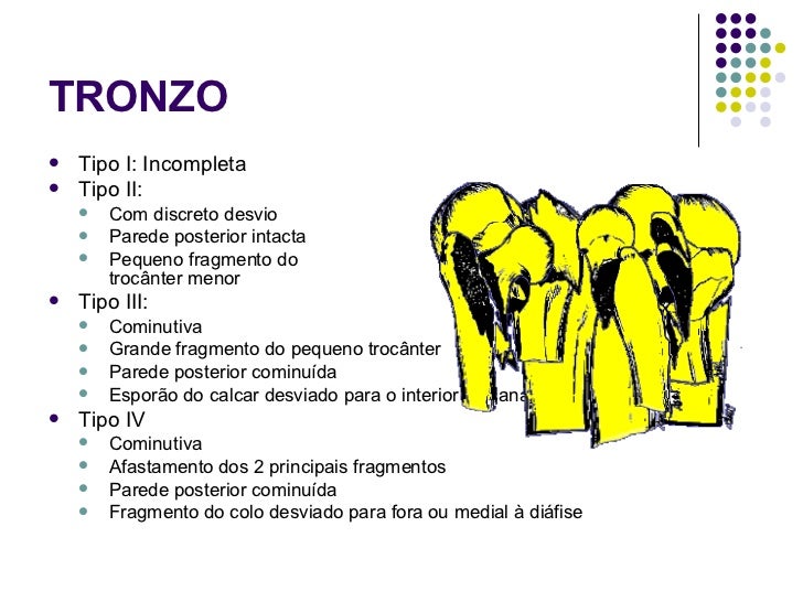 Fratura Transtrocanteriana