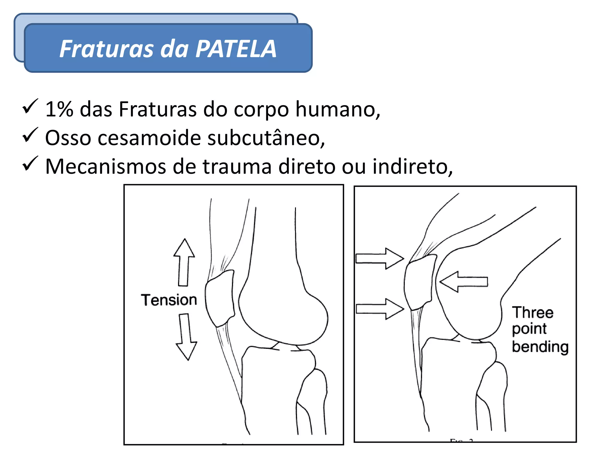 Fratura de patela | PPTX