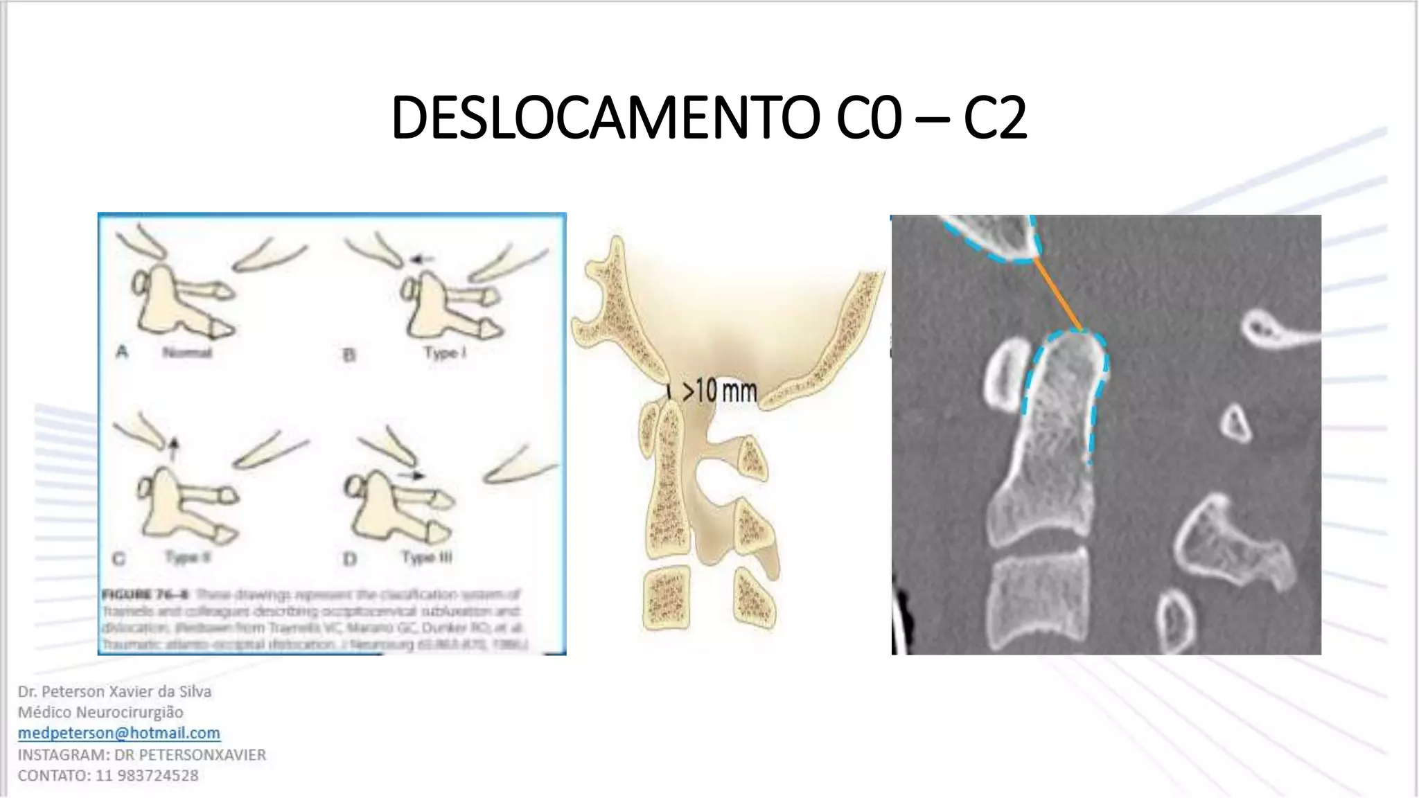 Fratura Occipito Cervical | PPT