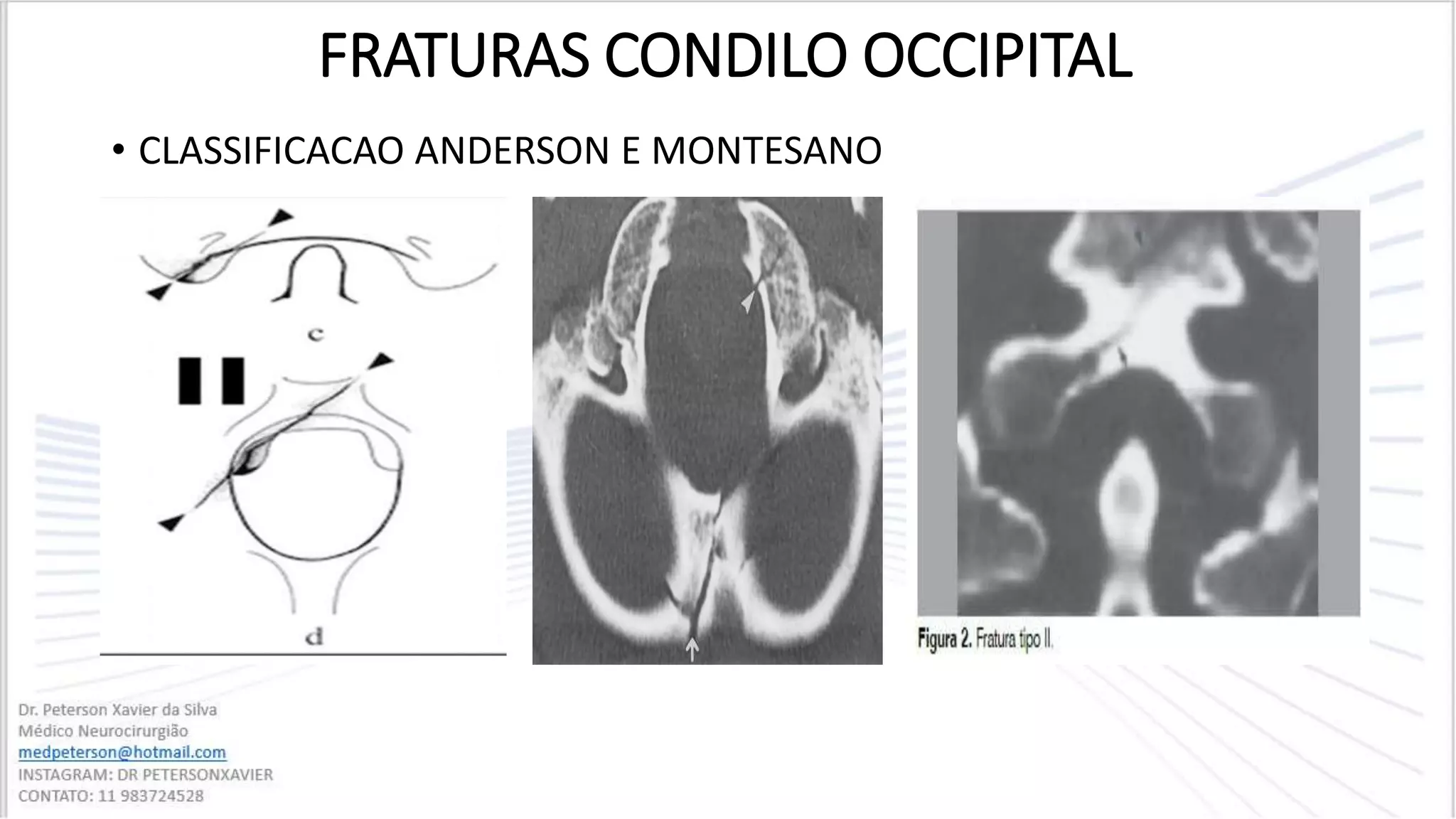 Fratura Do Condilo Occipital