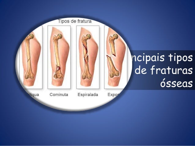 Fraturas