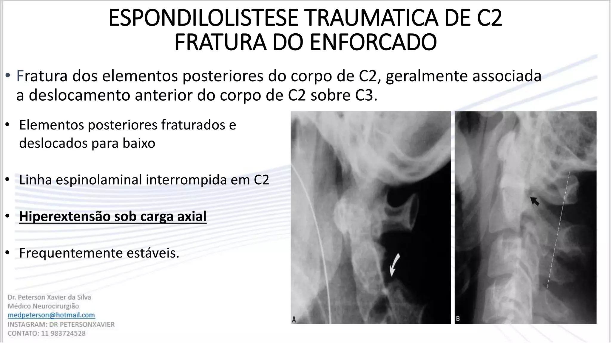 Fraturas de C2 (Odontoide) | PPTX