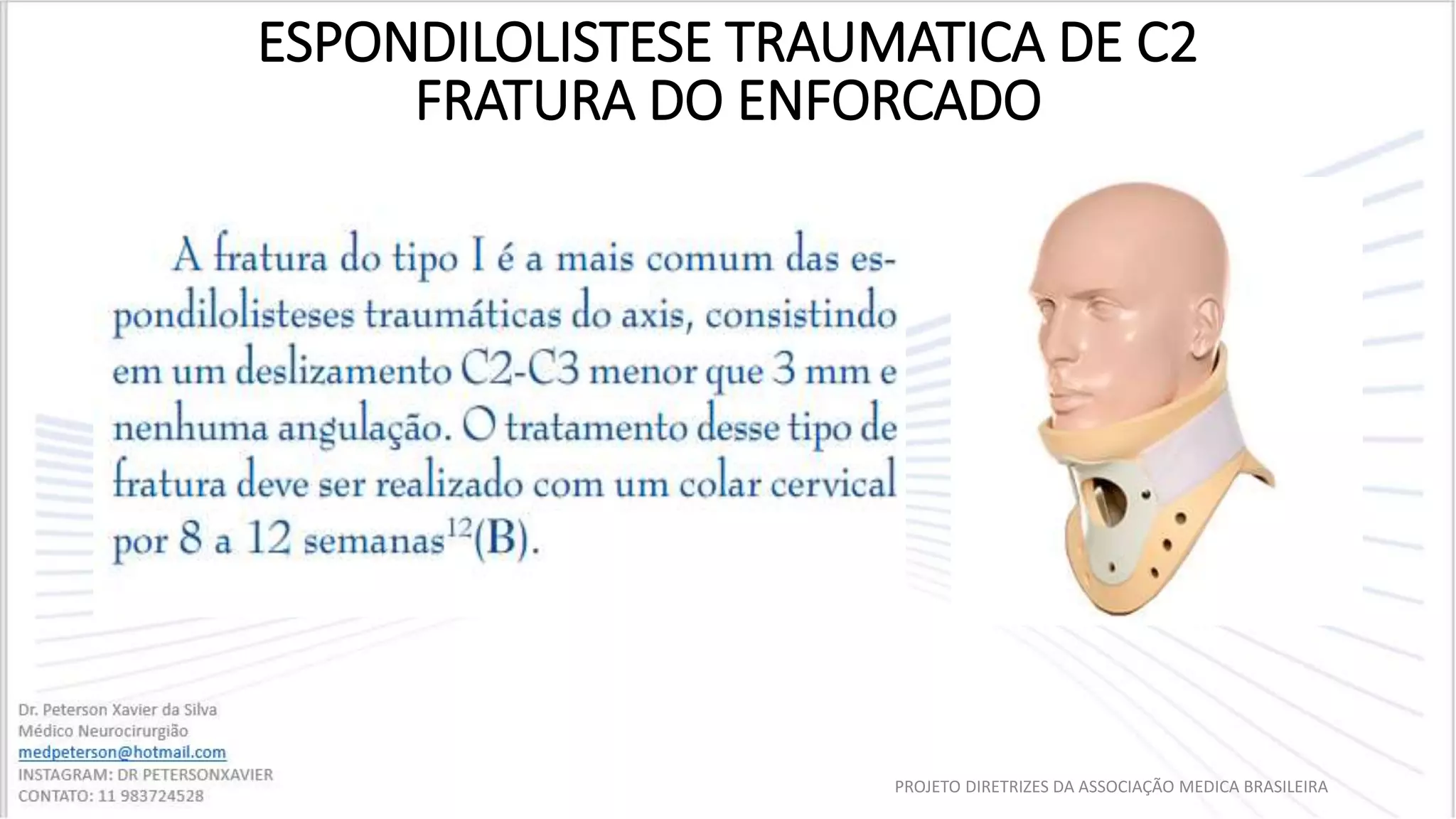 Fraturas de C2 (Odontoide) | PPTX