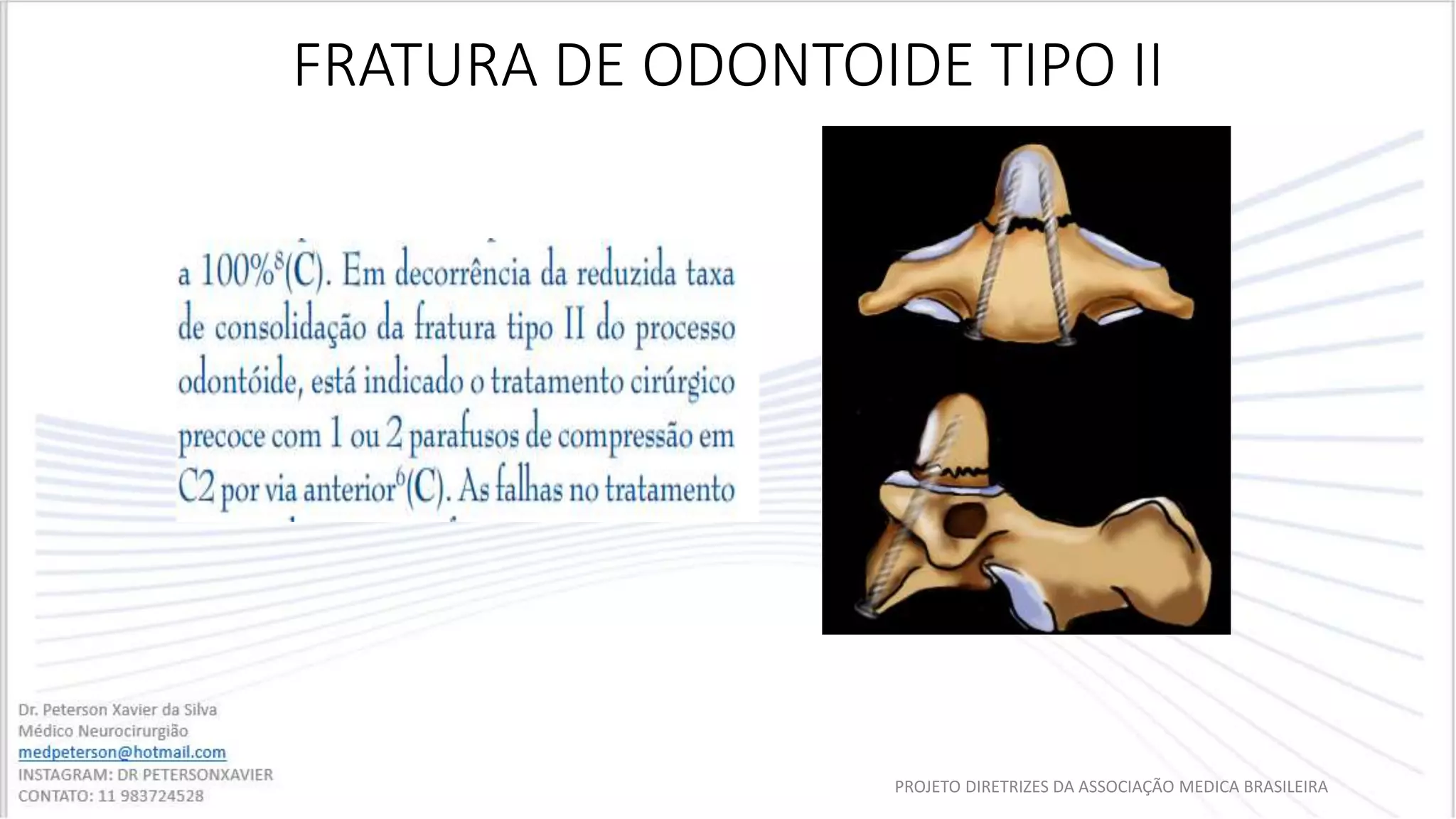 Fraturas de C2 (Odontoide) | PPTX