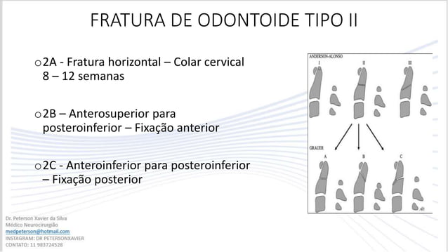 Fraturas de C2 (Odontoide) | PPTX