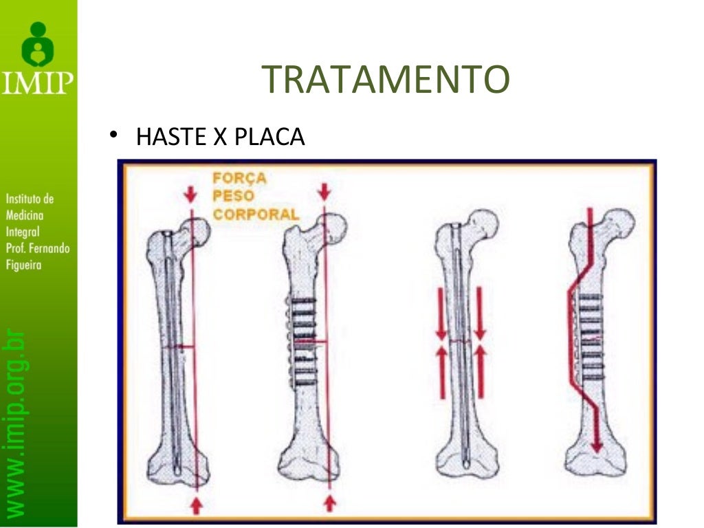 Fraturas diafisarias femur - AC