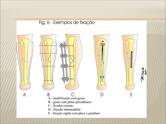 Fraturas Expostas | PPT