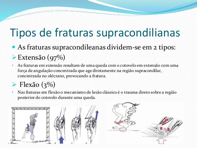 Fraturas supracondilianas Dr Omar Mohamad M. Abdallah