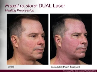 Fraxel for Great Skin | PPT