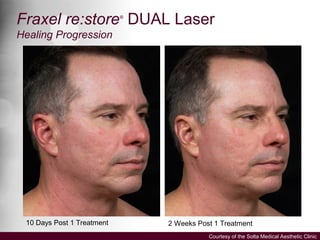 Fraxel for Great Skin | PPT