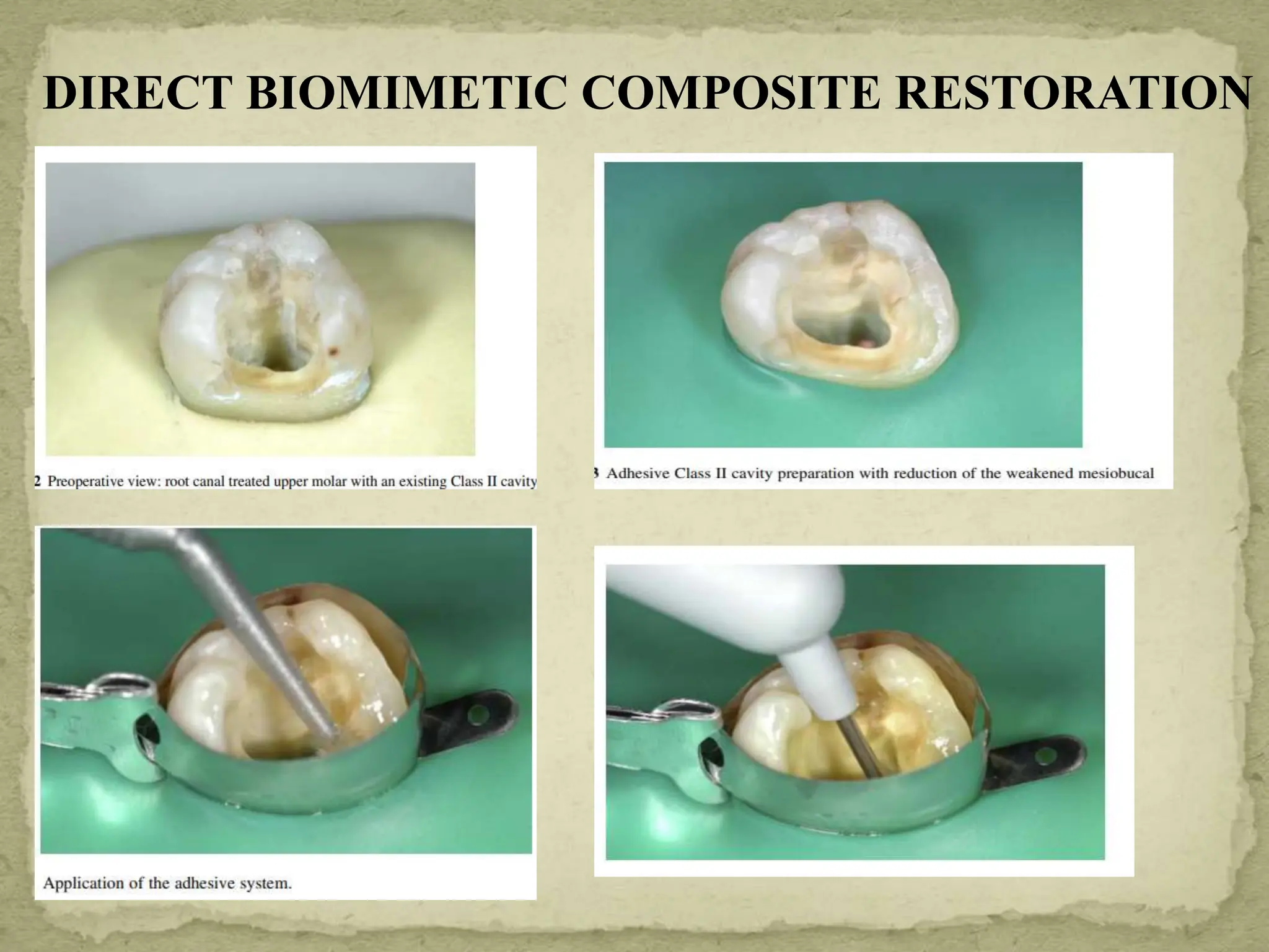 FIBRE REINFORCED COMPOSITE USEC IN CONSERVATIVE DENTISTRY AND ...