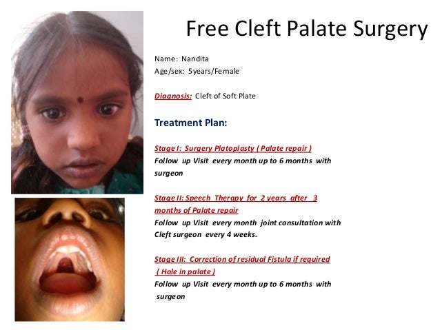 Free Cleft Palate Surgery