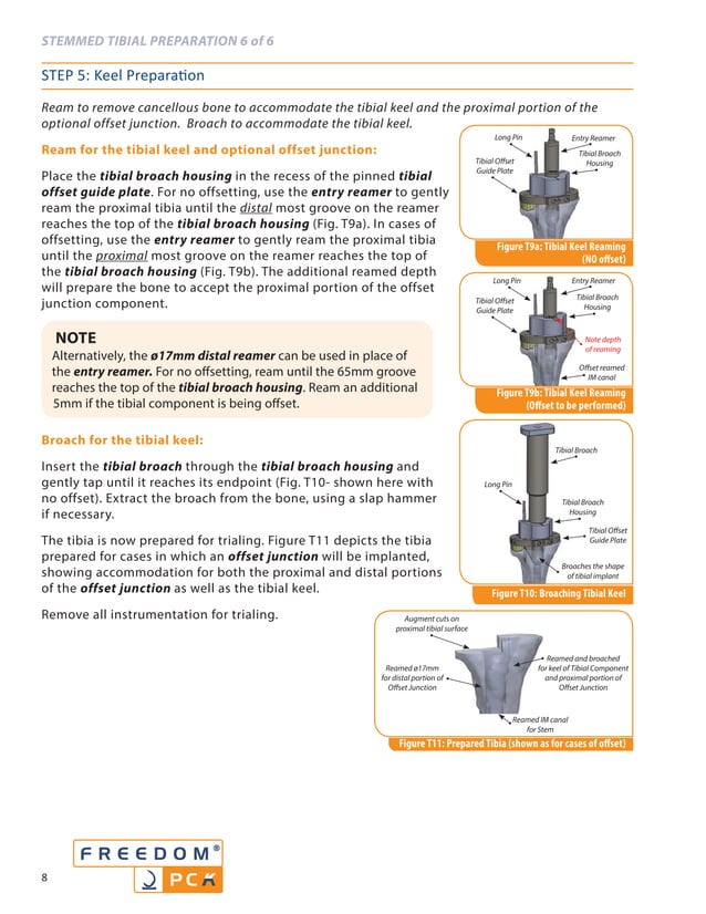 Freedom pck revision knee system by meril life | PDF | Bone and Joint ...