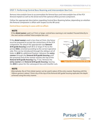 Freedom pck revision knee system by meril life | PDF