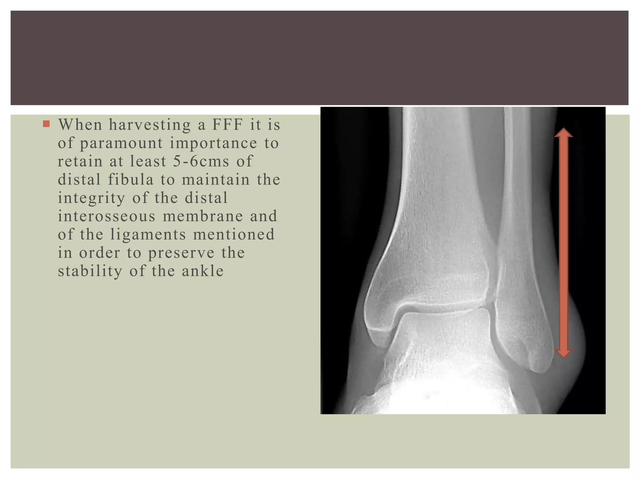 Free Fibula Osteocutaneous Flap | PPTX