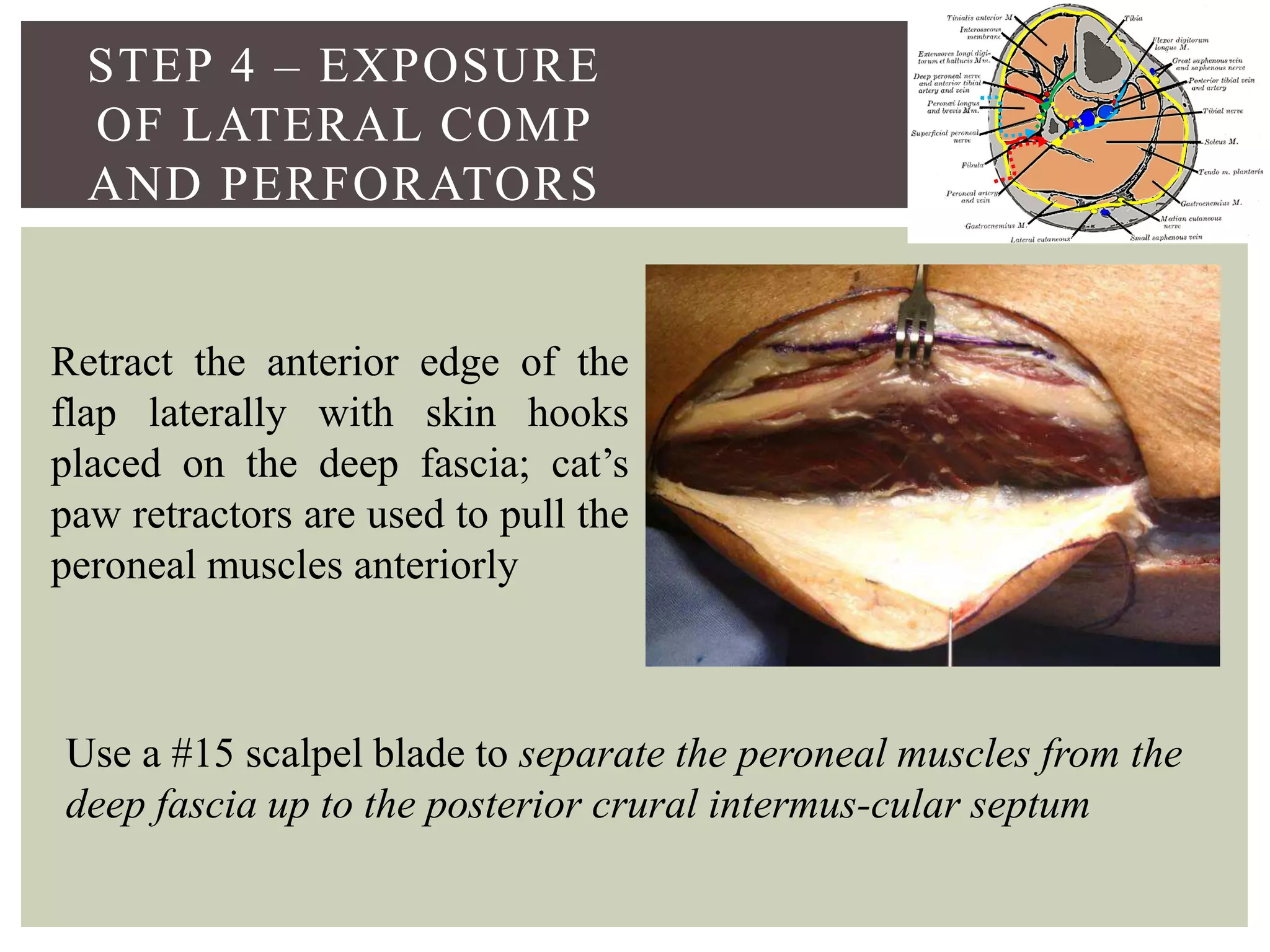 Free Fibula Osteocutaneous Flap | PPTX