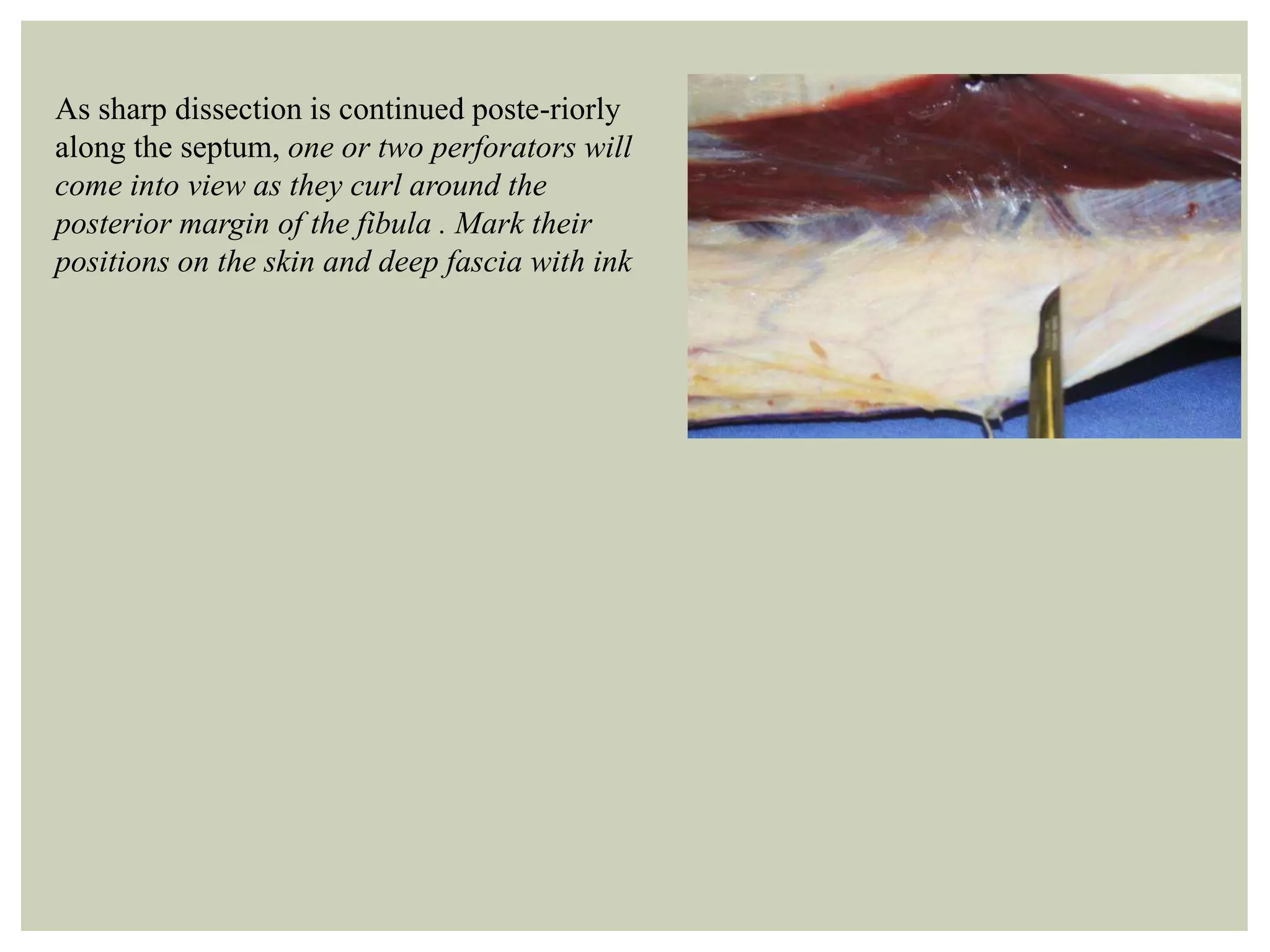 Free Fibula Osteocutaneous Flap | PPTX