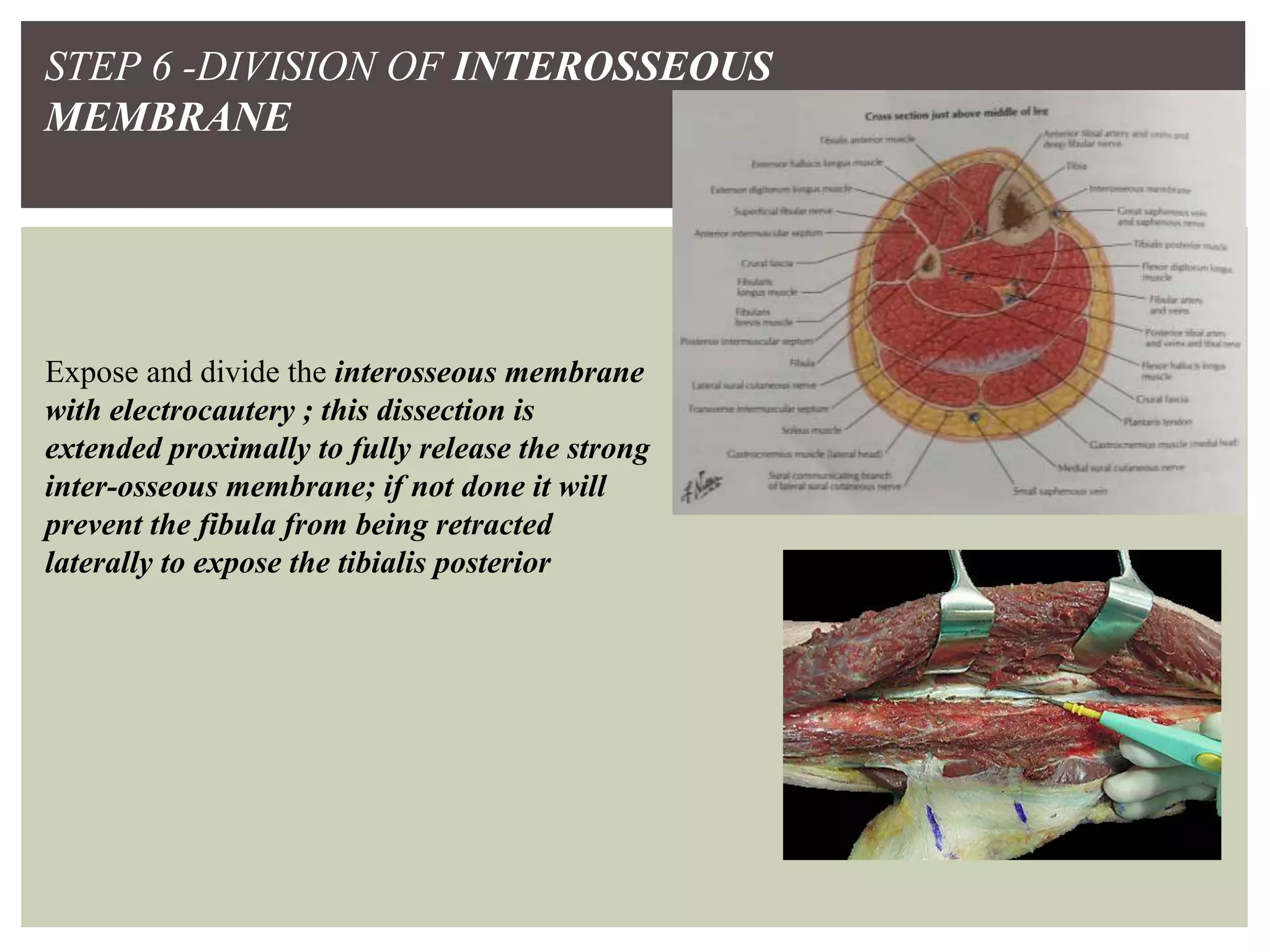 Free Fibula Osteocutaneous Flap | PPTX