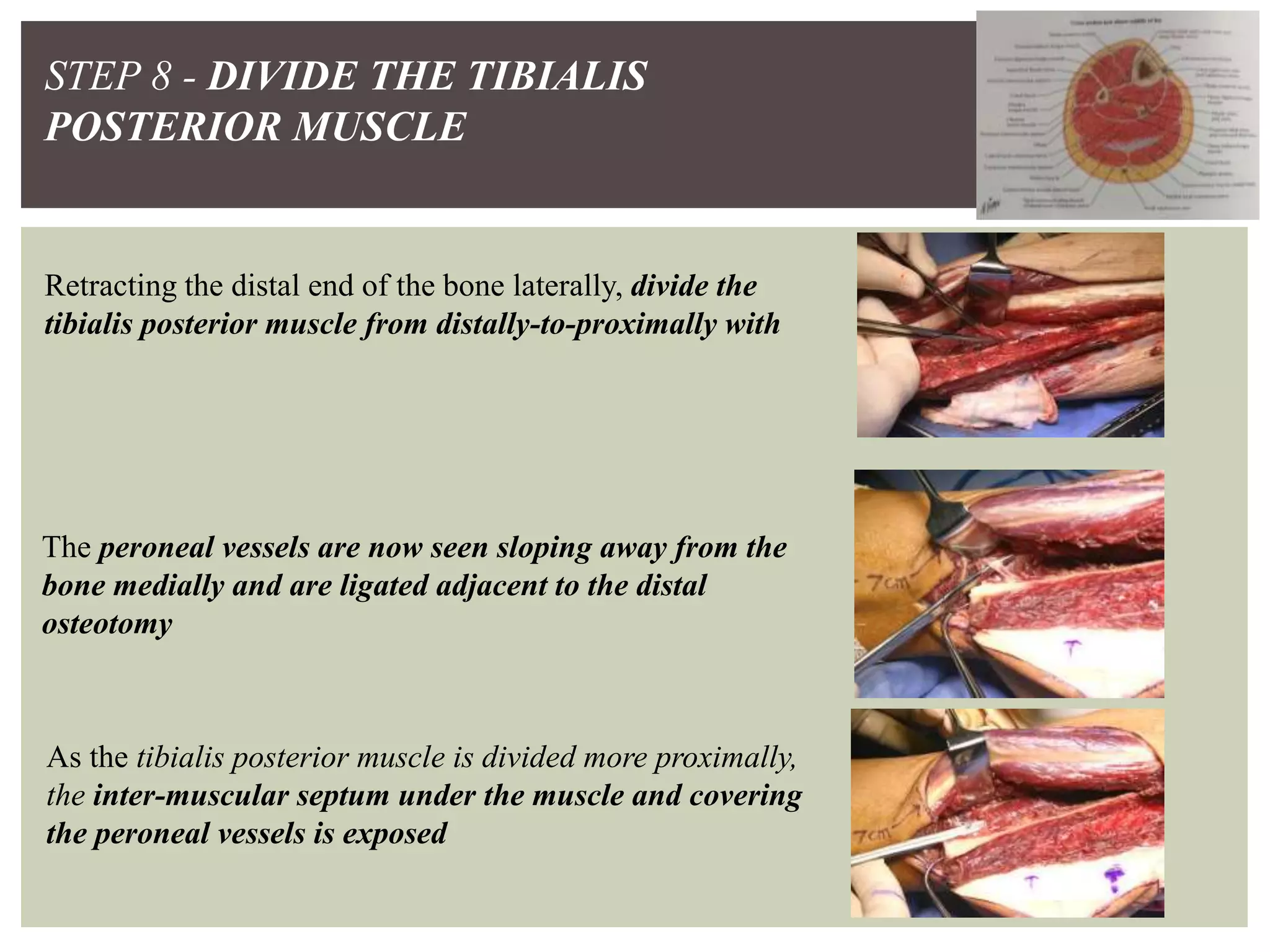 Free Fibula Osteocutaneous Flap | PPTX