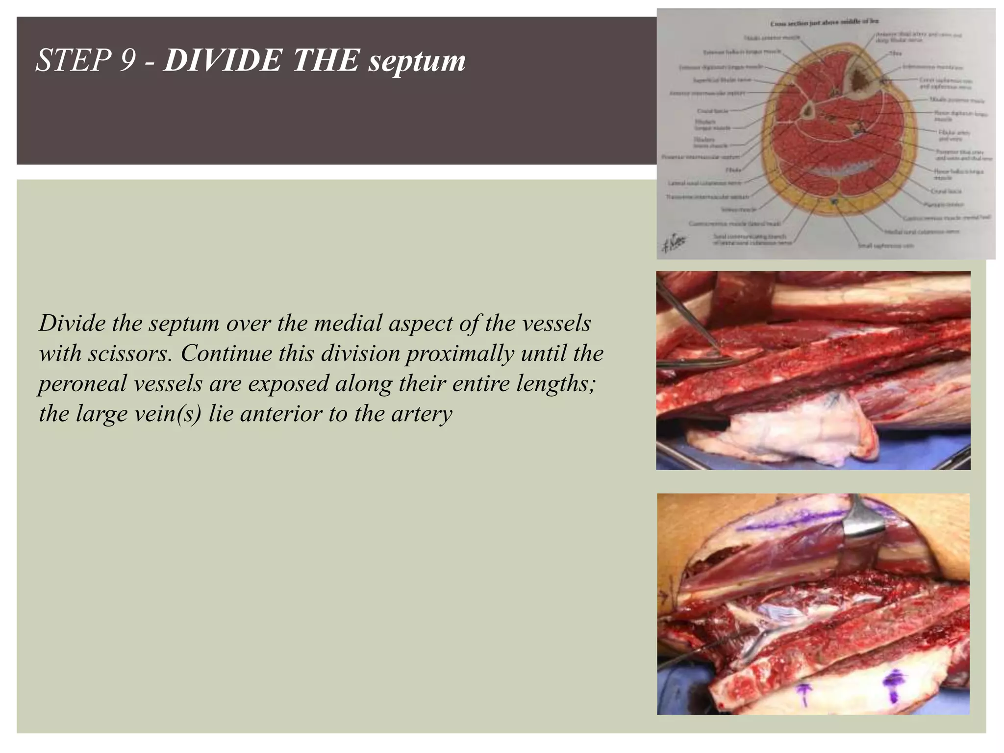 Free Fibula Osteocutaneous Flap | PPTX