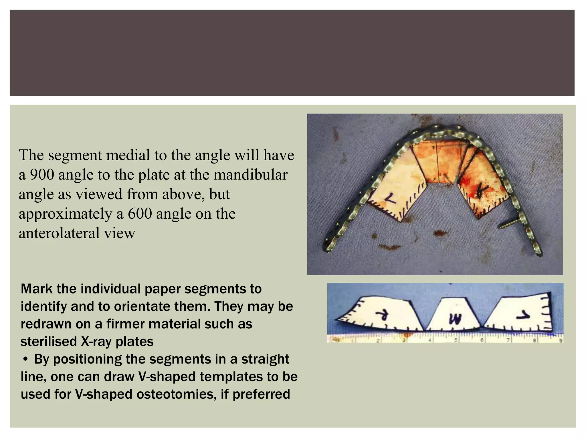 Free Fibula Osteocutaneous Flap | PPTX