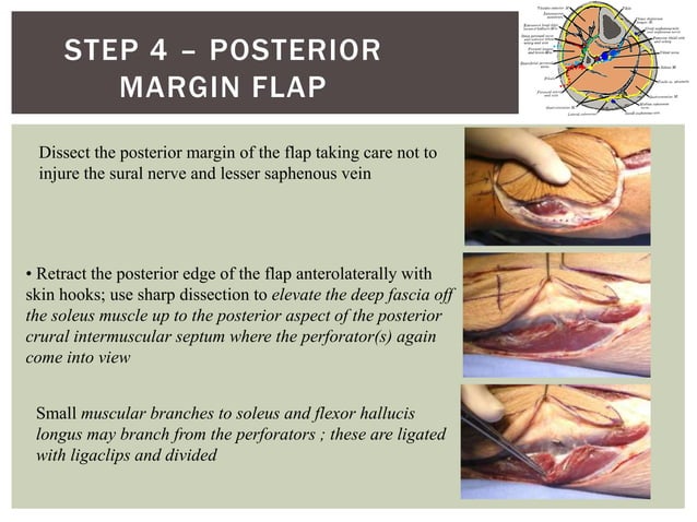 Free Fibula Osteocutaneous Flap | PPTX