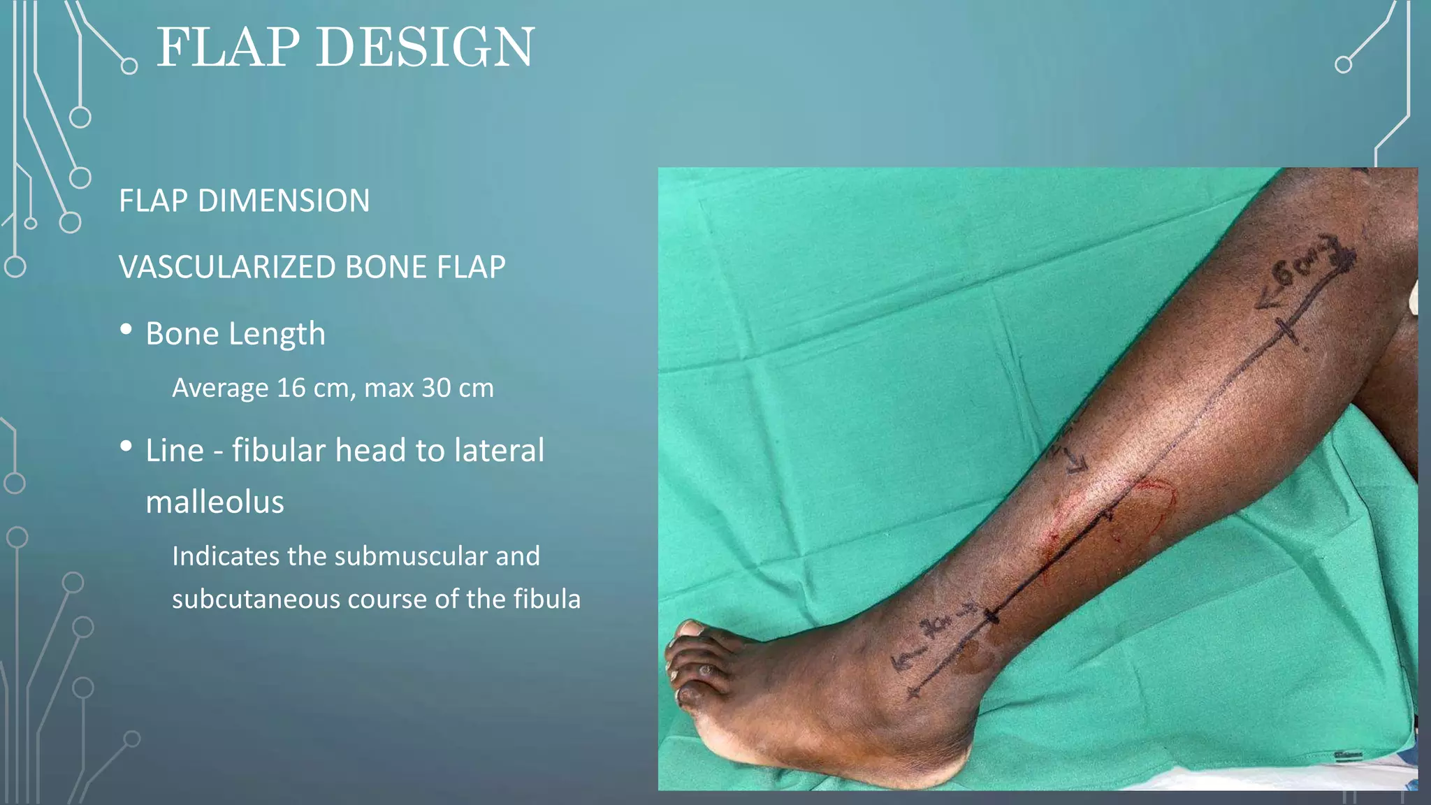 Free fibula flap OMFS 2021 journal club presentation | PPTX