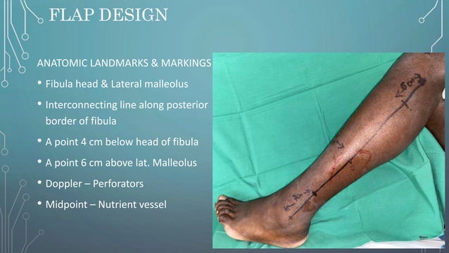 Free fibula flap OMFS 2021 journal club presentation | PPTX