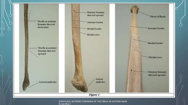 Free fibula flap OMFS 2021 journal club presentation | PPTX