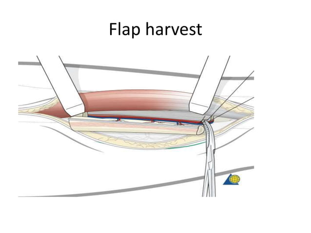 Free fibula flap technique | PPTX