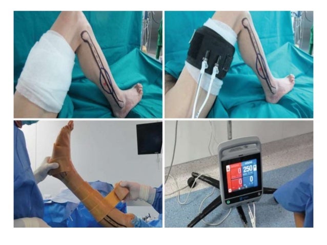 Free fibula flap technique