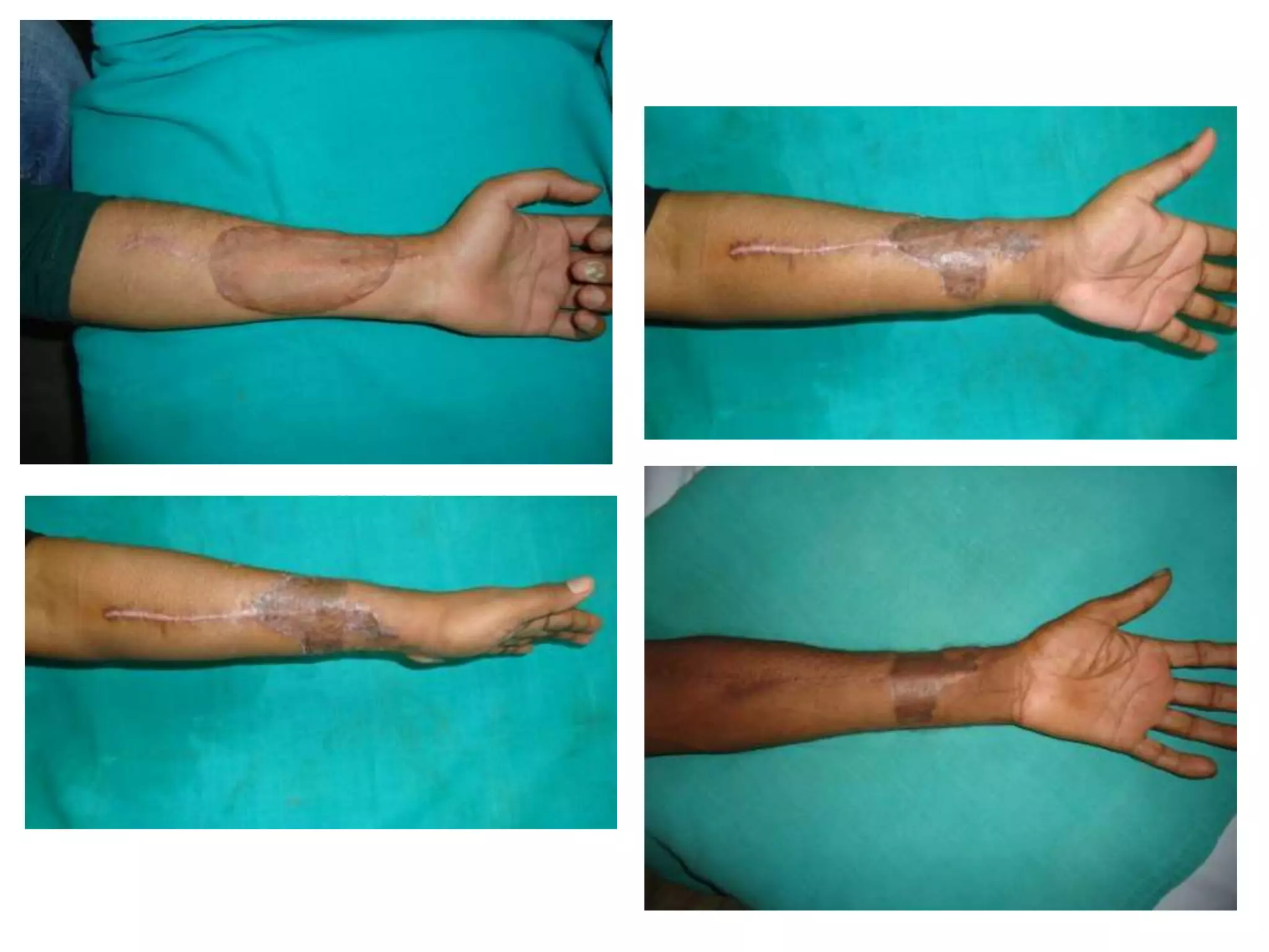 Free flaps in lower limb reconstruction | PPTX