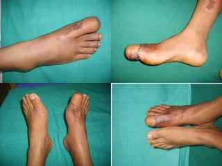 Free flaps in lower limb reconstruction | PPTX