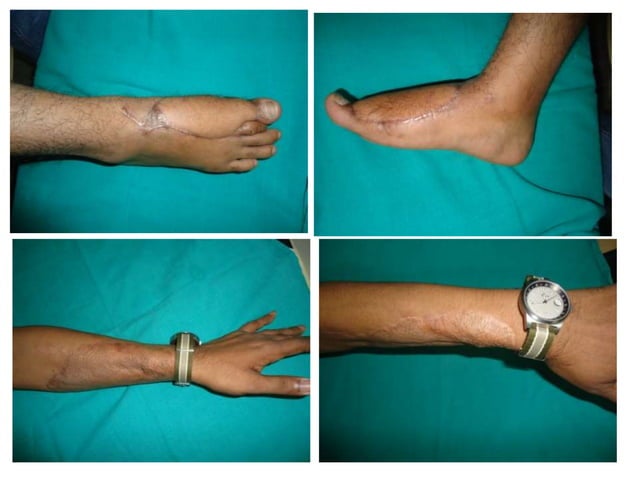 Free flaps in lower limb reconstruction | PPTX