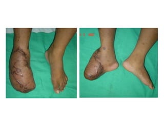Free flaps in lower limb reconstruction | PPTX