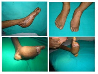 Free flaps in lower limb reconstruction | PPTX