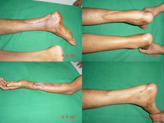 Free flaps in lower limb reconstruction | PPTX