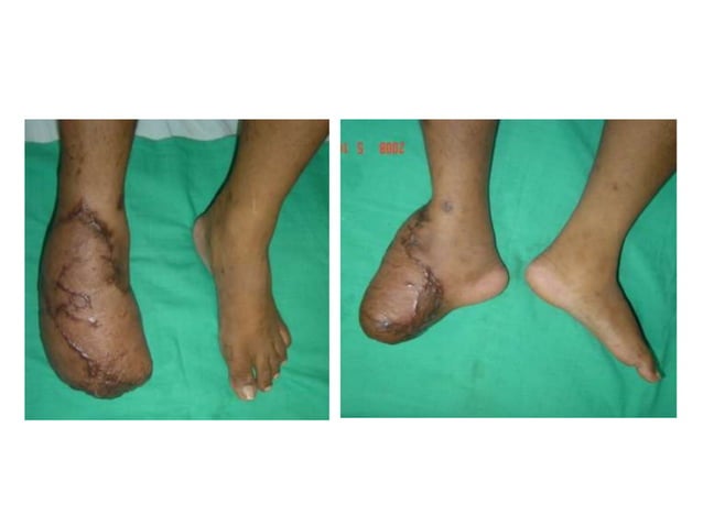 Free flaps in lower limb reconstruction | PPT