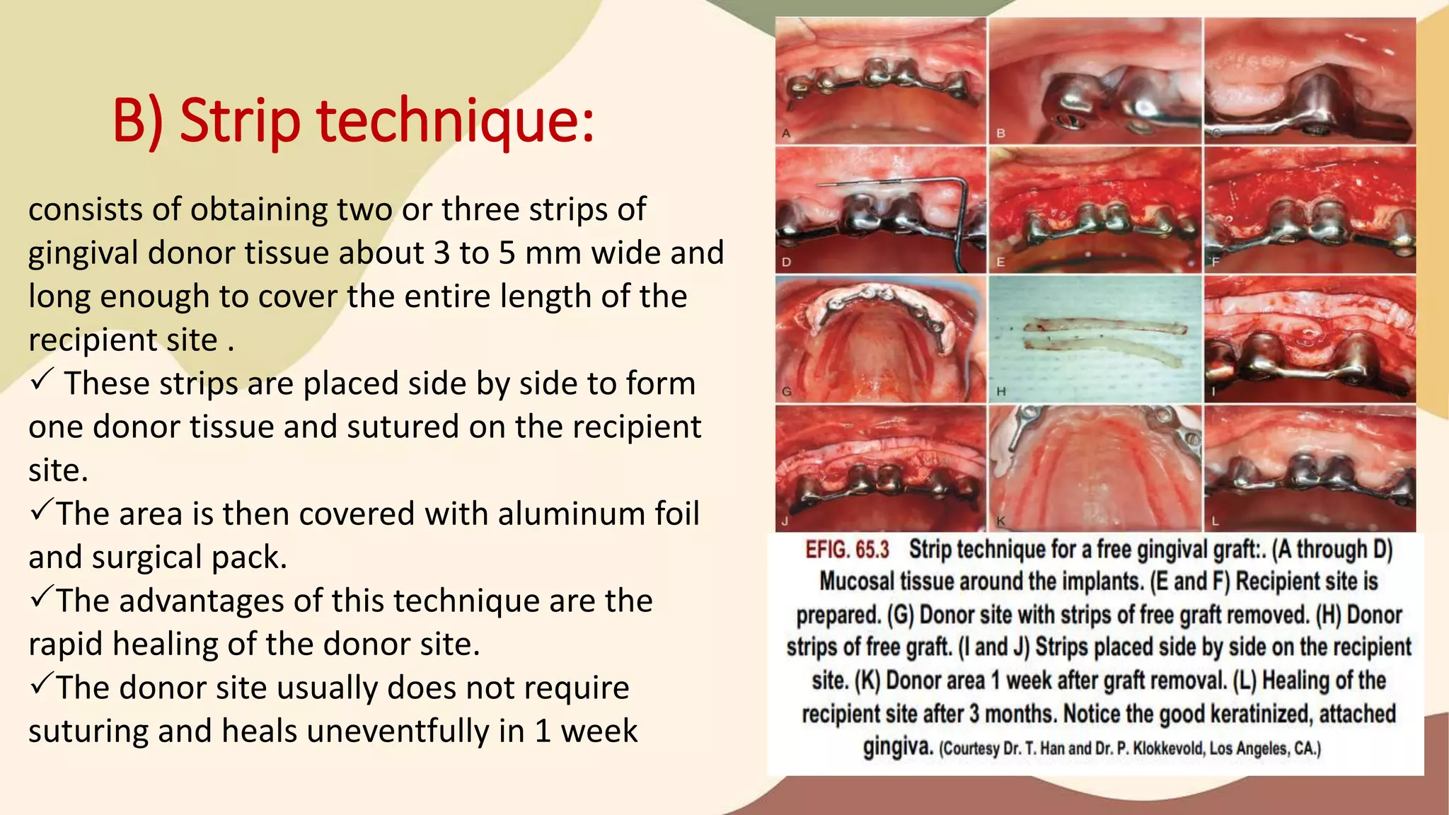 Free gingival graft | PPTX