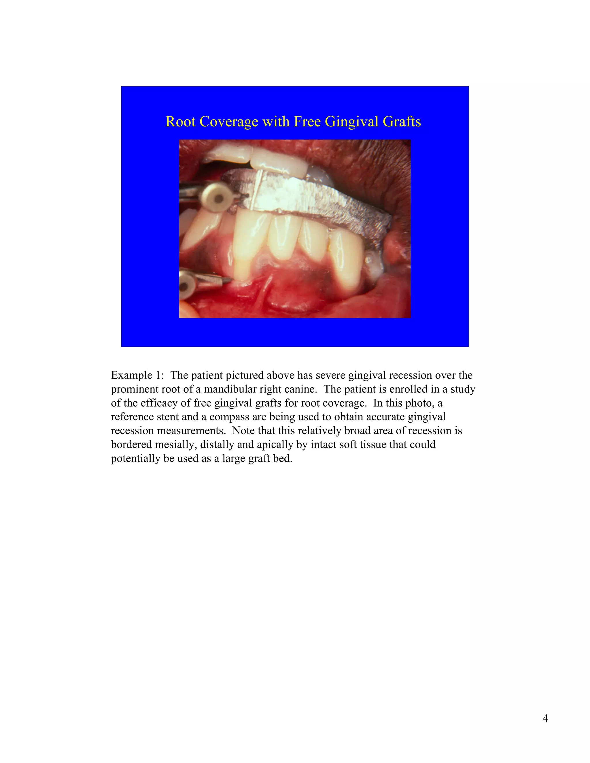Free gingival grafts | PDF