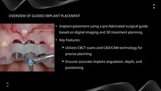 Free hand vs Guided Implant Placement.pptx