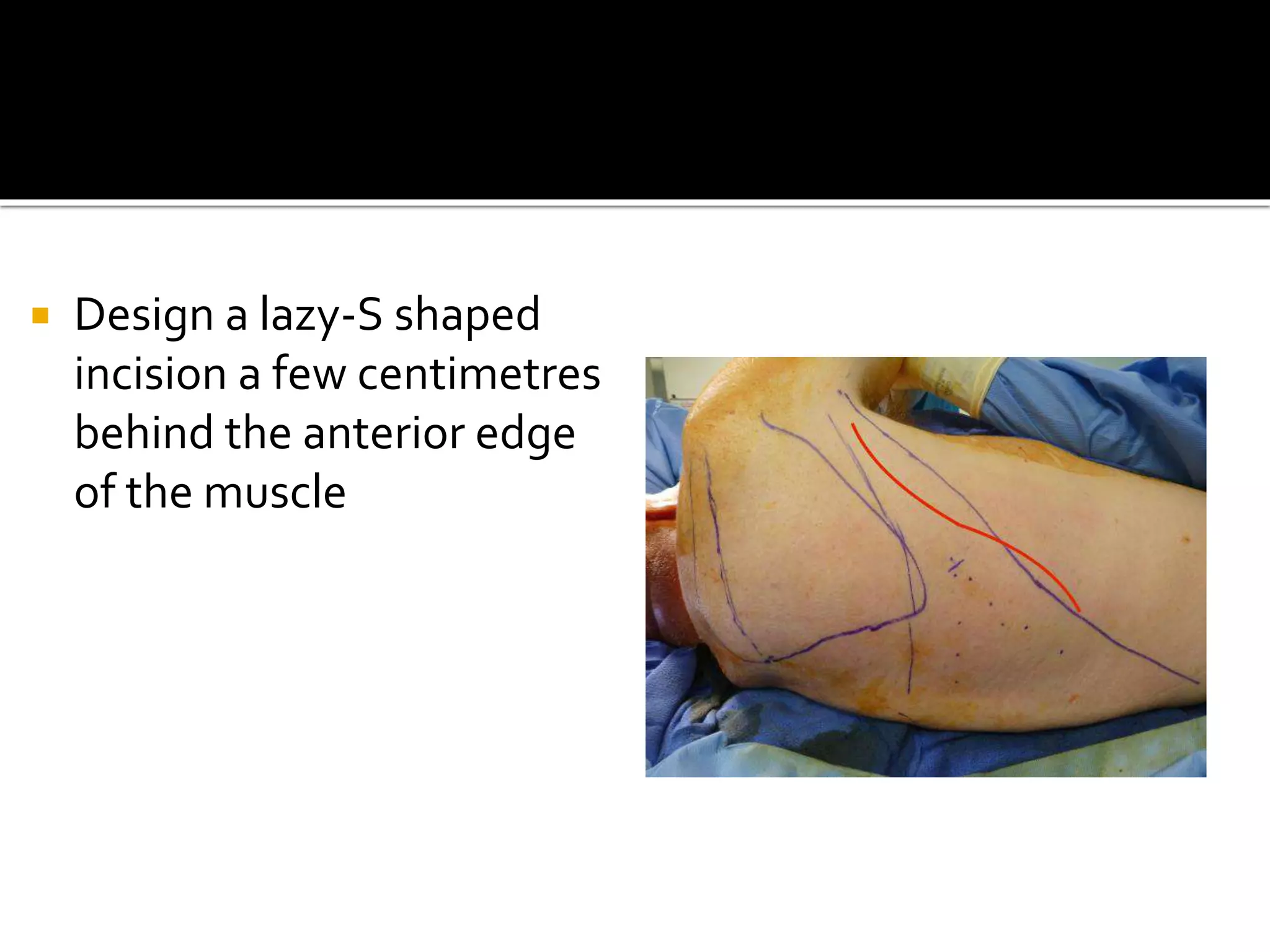 Free LD flap for scalp reconstruction DR VIPIN V NAIR | PPTX | Death ...