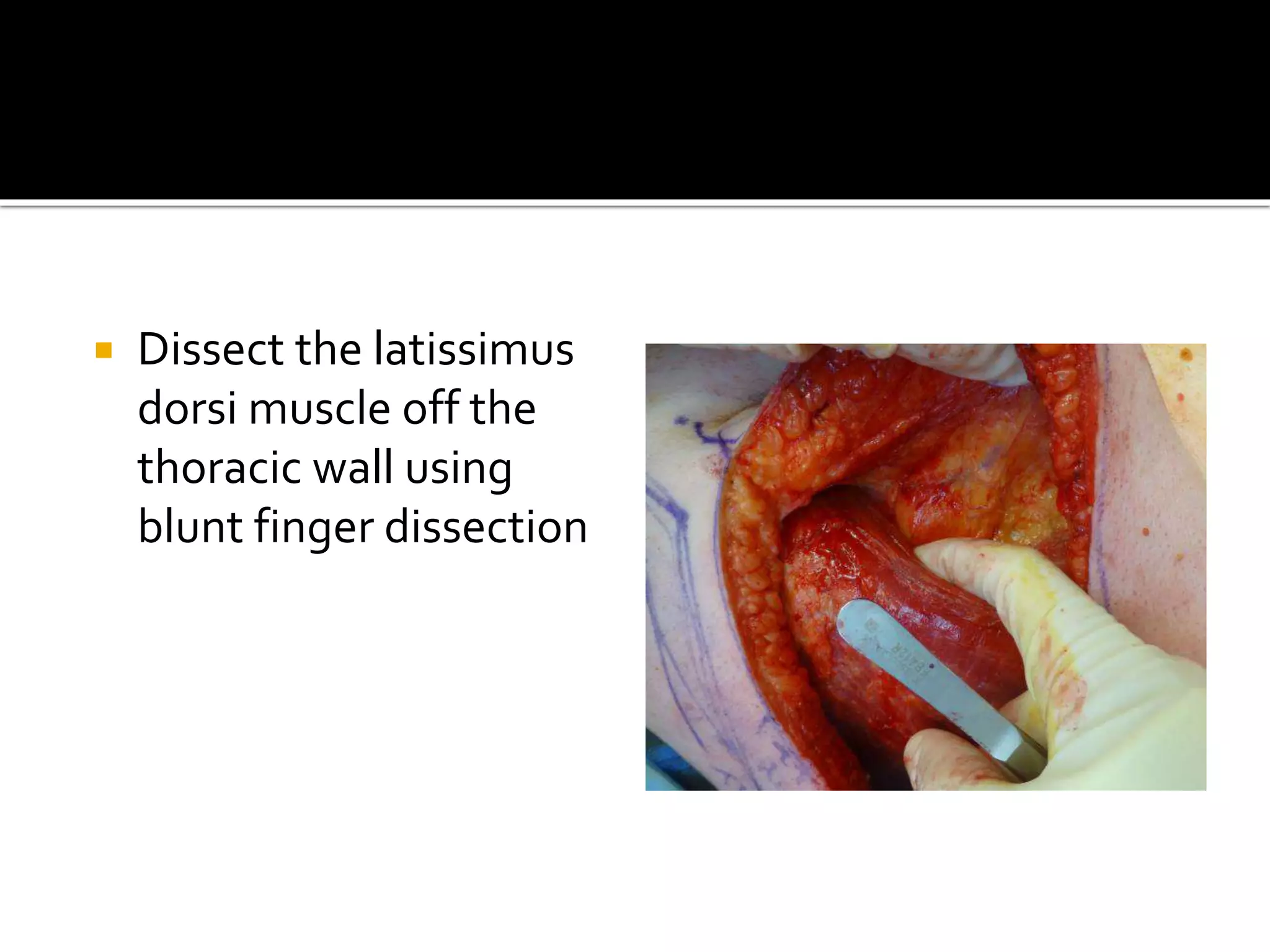 Free LD flap for scalp reconstruction DR VIPIN V NAIR | PPTX | Death ...