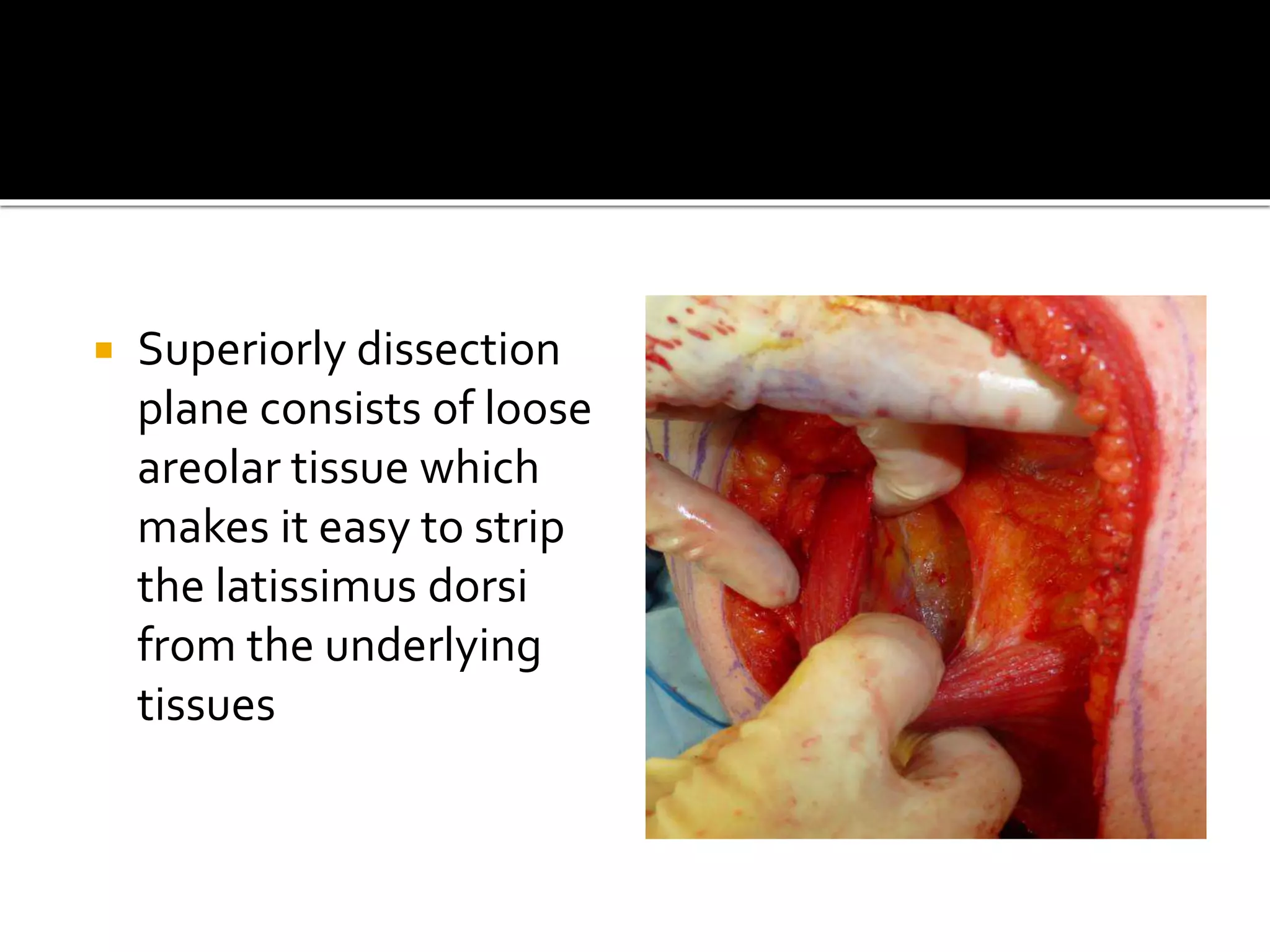 Free LD flap for scalp reconstruction DR VIPIN V NAIR | PPTX | Death ...