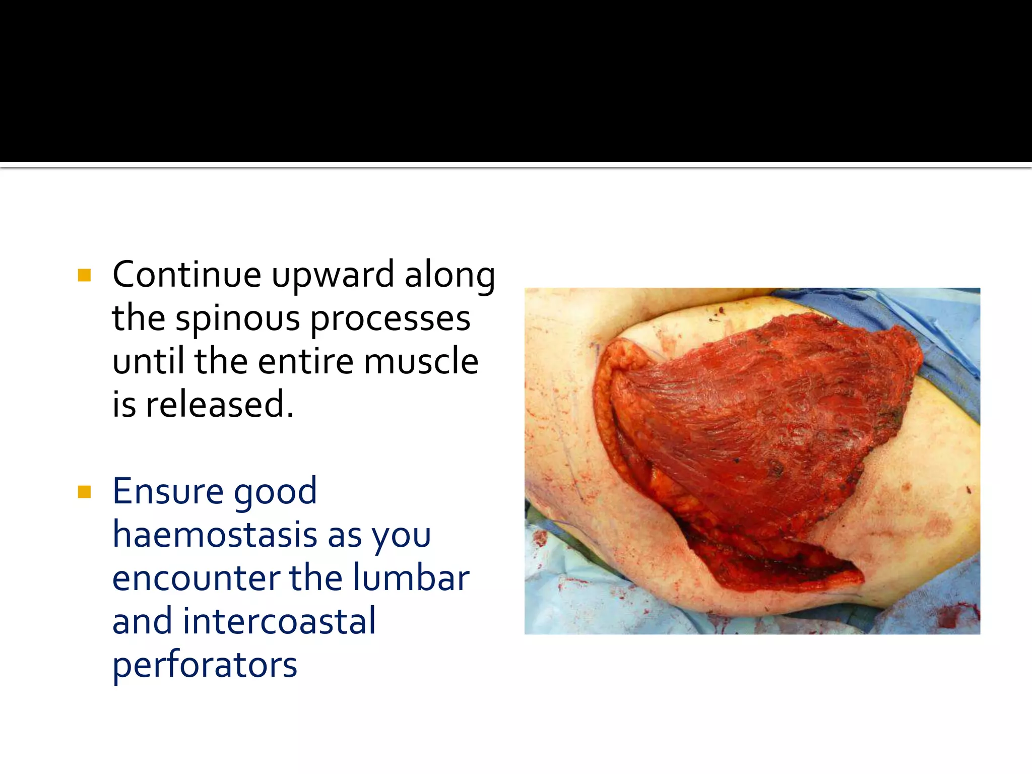 Free LD flap for scalp reconstruction DR VIPIN V NAIR | PPTX | Death ...