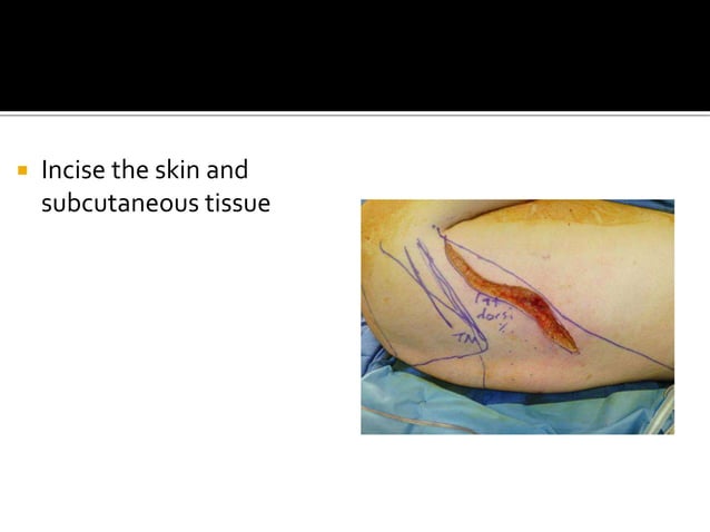 Free LD flap for scalp reconstruction DR VIPIN V NAIR | PPTX | Death ...